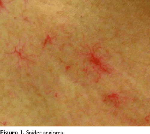 Figure 5 from Stigmata of Chronic Liver Disease | Semantic Scholar