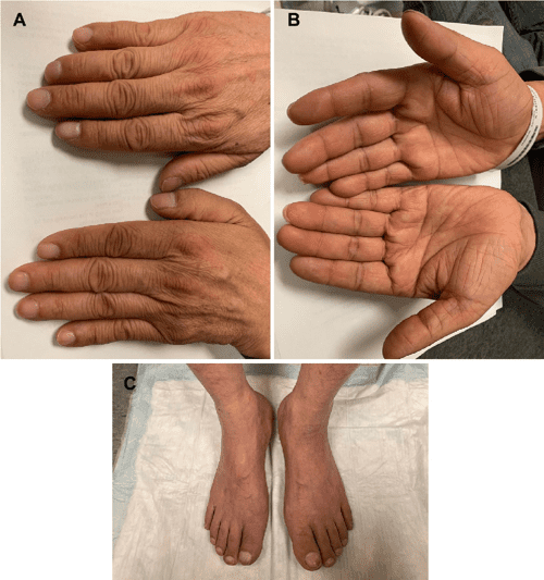 Digital ischemia in Behçet’s disease: case-based review | Semantic Scholar