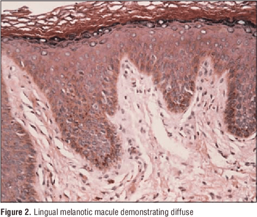 Figure 2 from The congenital lingual melanotic macule. | Semantic Scholar