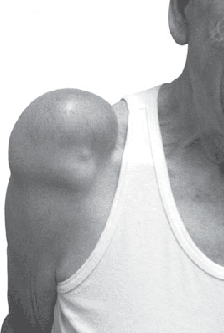 Figure 3 from Management of a Massive Acromioclavicular Joint Cyst: The ...