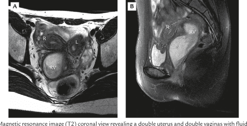 Figure 1 from Resectoscopic excision of the vaginal septum in a virgin ...