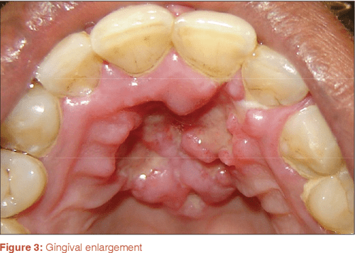 Oral manifestations of tuberculosis | Semantic Scholar