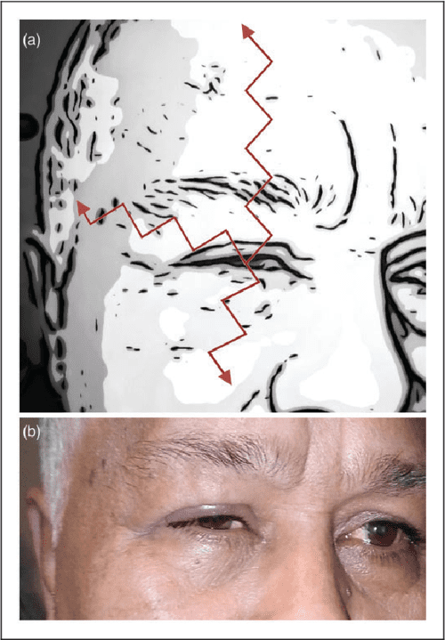 Case report: Wallenberg’s syndrome, a possible cause of symptomatic ...