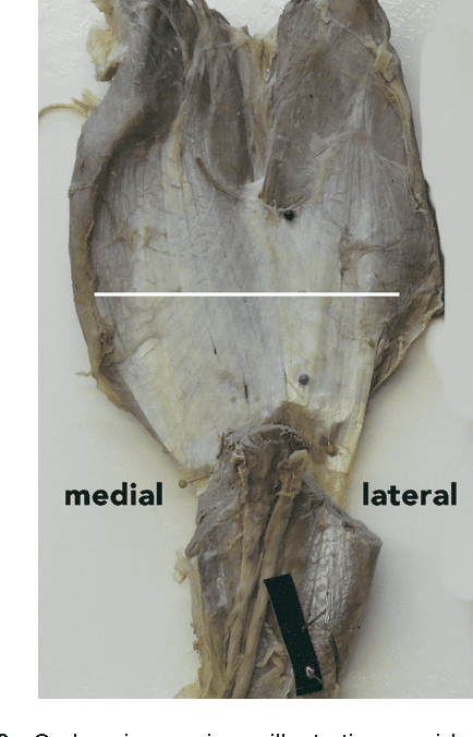 Figure 1 from Anatomical aspects of the gastrocnemius aponeurosis and ...