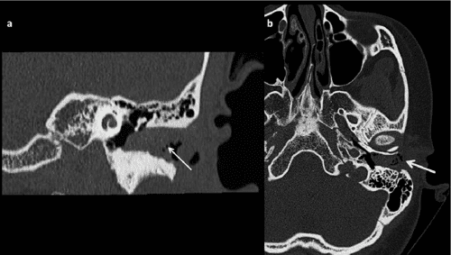 High resolution CT of external ear and external auditory canal ...