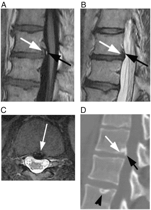 Imaging features of posterior limbus vertebrae. | Semantic Scholar