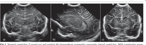 Figure 9 from Neonatal head ultrasound: systematic approach to ...