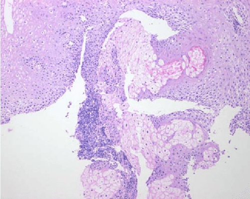 Figure 1 from An esophageal xanthoma diagnosed by upper ...