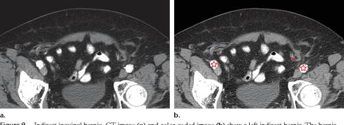 Figure 12 from Diagnosis of inguinal region hernias with axial CT: the ...