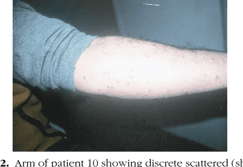 Figure 1 from A new cutaneous sign of mercury poisoning. | Semantic Scholar