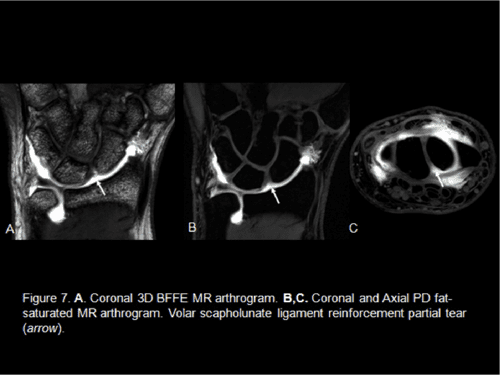 Arthro-MRI findings on TFCC lesions and intrinsic ligaments of the ...
