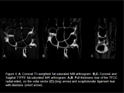 Arthro-MRI findings on TFCC lesions and intrinsic ligaments of the ...