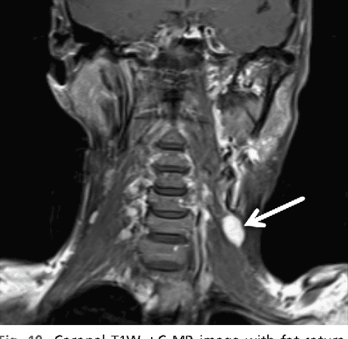 Figure 1 from Imaging of the perivertebral space. | Semantic Scholar