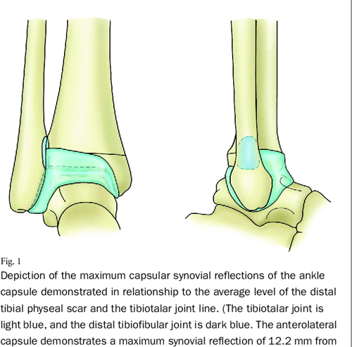 Figure 2 from Extracapsular placement of distal tibial transfixation ...