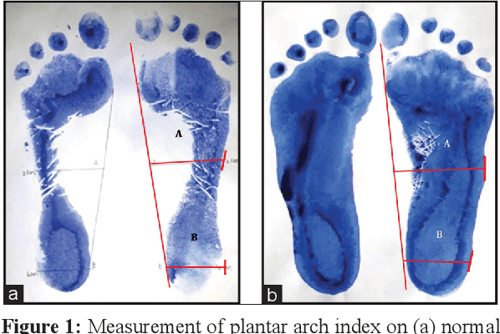 [PDF] Determination of flat foot by footprint analysis using plantar ...