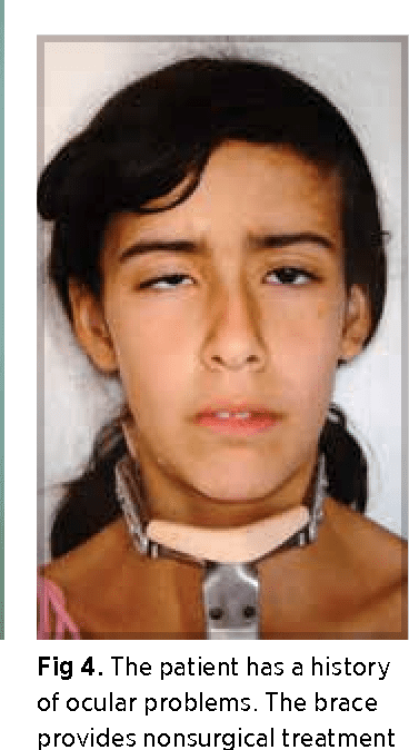 Figure 8 from Oral management of Marfan syndrome: an overview and case ...