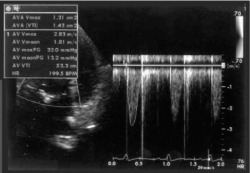 Figure 2 from A case of aortic valve replacement with St. Jude Medical ...
