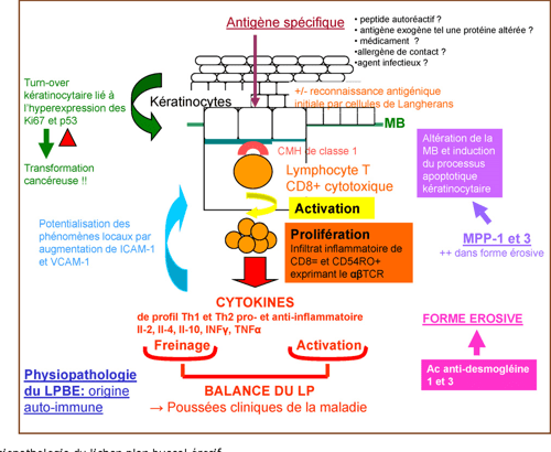 Figure 1 from LINIQUE ichen plan buccal érosif rosive oral lichen ...