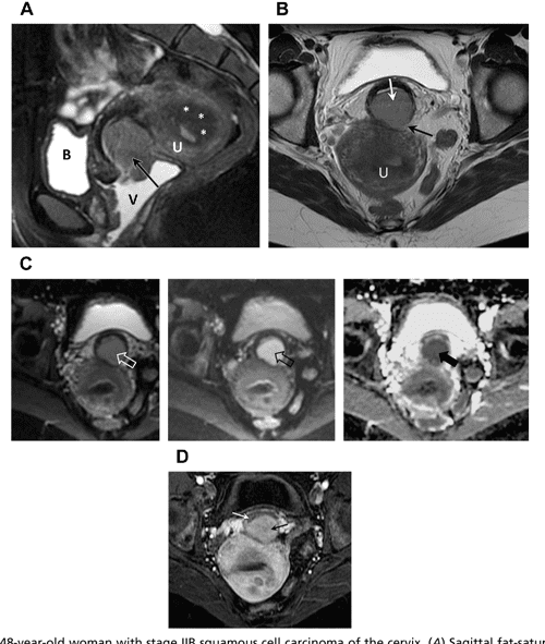 Figure 1 from MR Imaging in Cervical Cancer: Initial Staging and ...