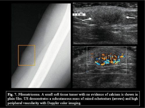 BENIGN LESIONS OF THE SUBCUTANEOUS SOFT TISSUE WITH CALCIFICATIONS ...