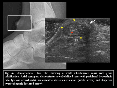 Figure 14 from BENIGN LESIONS OF THE SUBCUTANEOUS SOFT TISSUE WITH ...
