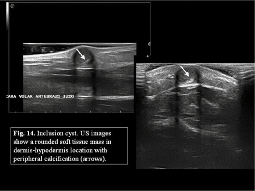 BENIGN LESIONS OF THE SUBCUTANEOUS SOFT TISSUE WITH CALCIFICATIONS ...