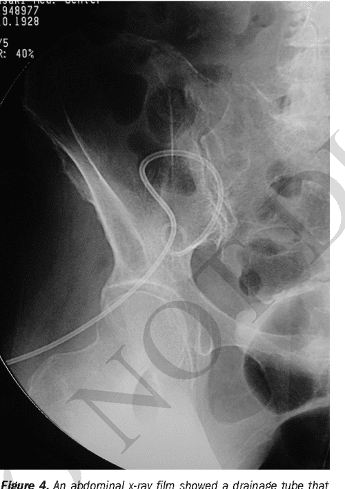 Figure 9 from Iliopsoas muscle abscess secondary to sacral pressure ...