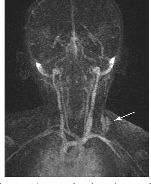 Figure 5 from Pediatric jugular vein aneurysm (phlebectasia): report of ...