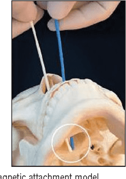 [PDF] Nasal Bridle : Married to Your Tube CASE SCENARIOS | Semantic Scholar
