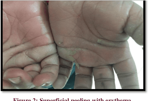 Figure 1 from Acral peeling skin syndrome | Semantic Scholar