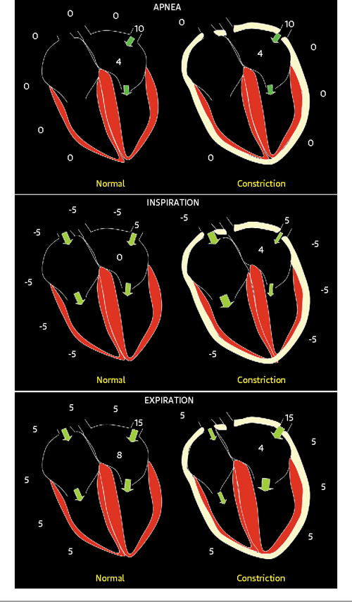 Table 2 from Constrictive Pericarditis Versus Restrictive ...