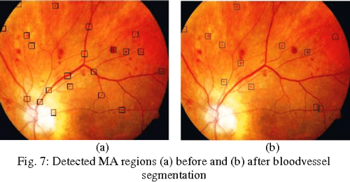 Microaneurysm Detection in Digital Retinal Images Using Blood Vessel ...
