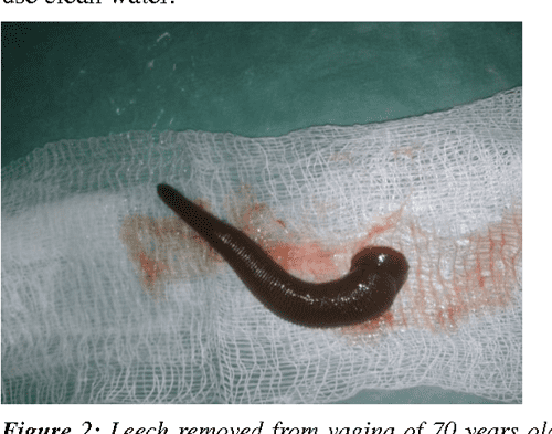 Figure 1 from Vaginal Leech Infestation: A Rare Cause of Hypovolumic ...