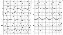 [PDF] ABERRANT VENTRICULAR CONDUCTION TYPES AND CONCEALED | Semantic ...
