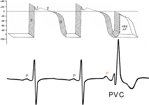 Figure 4 from ABERRANT VENTRICULAR CONDUCTION TYPES AND CONCEALED ...