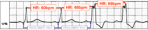 [PDF] ABERRANT VENTRICULAR CONDUCTION TYPES AND CONCEALED | Semantic ...