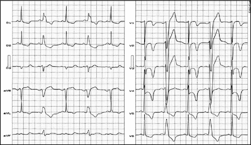 Figure 4 from ABERRANT VENTRICULAR CONDUCTION TYPES AND CONCEALED ...