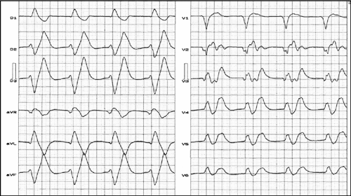 Figure 4 from ABERRANT VENTRICULAR CONDUCTION TYPES AND CONCEALED ...