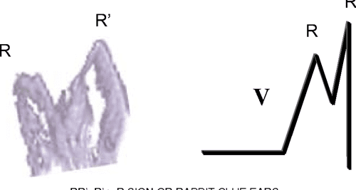 [PDF] ABERRANT VENTRICULAR CONDUCTION TYPES AND CONCEALED | Semantic ...