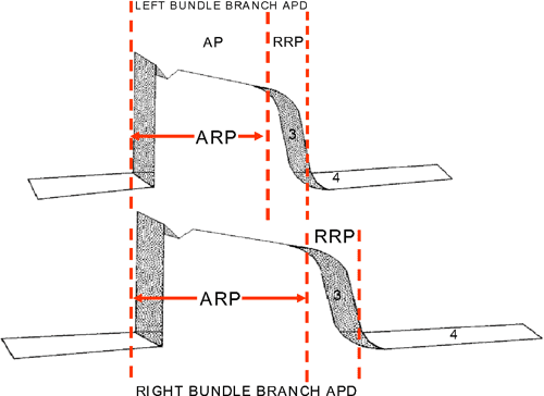 [PDF] ABERRANT VENTRICULAR CONDUCTION TYPES AND CONCEALED | Semantic ...