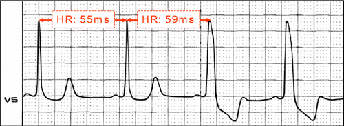 Figure 4 from ABERRANT VENTRICULAR CONDUCTION TYPES AND CONCEALED ...