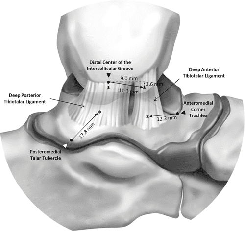 Figure 4 from The ligament anatomy of the deltoid complex of the ankle ...