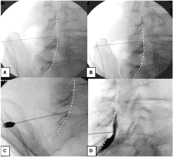 [PDF] Contralateral Oblique View Is Superior to the Lateral View for ...