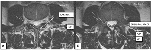 [PDF] Contralateral Oblique View Is Superior to the Lateral View for ...