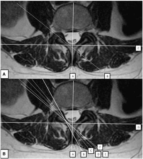 [PDF] Contralateral Oblique View Is Superior to the Lateral View for ...