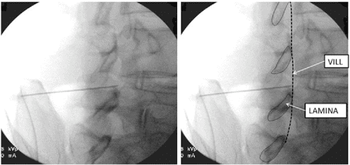 Table 1 from Contralateral Oblique View Is Superior to the Lateral View ...