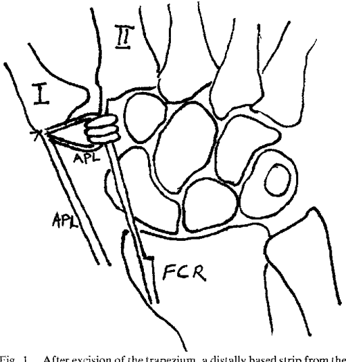 Figure 2 from Weilby Tendon Interposition Arthroplasty for ...