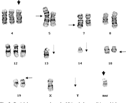 Figure 1 from Occurrence of trisomy 12, t(14;18)(q32;q21), and t(8;14 ...