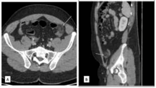 Aspects tomodensitometriques de l’appendagite épiploïque : à propos de ...