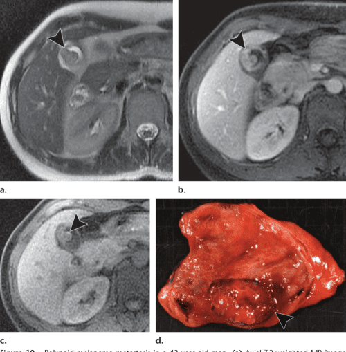 Figure 1 from Polypoid lesions of the gallbladder: disease spectrum ...